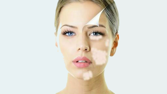 7 Effective Home Remedies for Vitiligo to Reduce Pesky White Patches