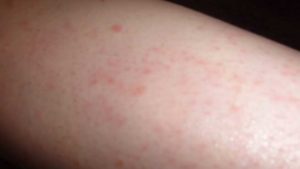 How to Prevent and Get Rid of Bumps after Waxing