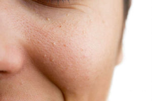 Get Rid Of Oil Bumps: Causes, Types, Treatments, And Prevention