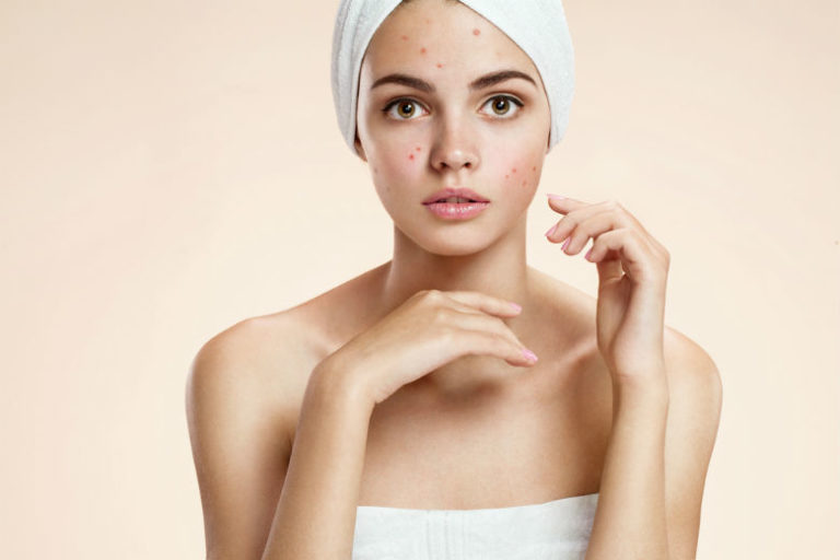 10 Best Acne Soaps Available In India to Keep Your Pesky Acne Away