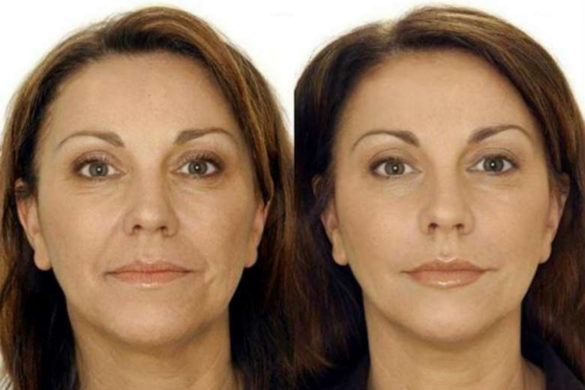 Aquamid Filler Injections - Procedure, Side Effects, Cost & Recovery Time
