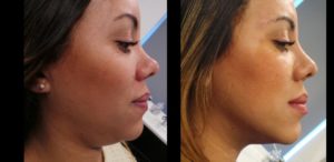 Aqualyx Injections For Stubborn Fat - Procedure, Cost, Side Effects