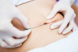 Belly Button Surgery Procedure Costs And Side Effects Before And After Pic 4530