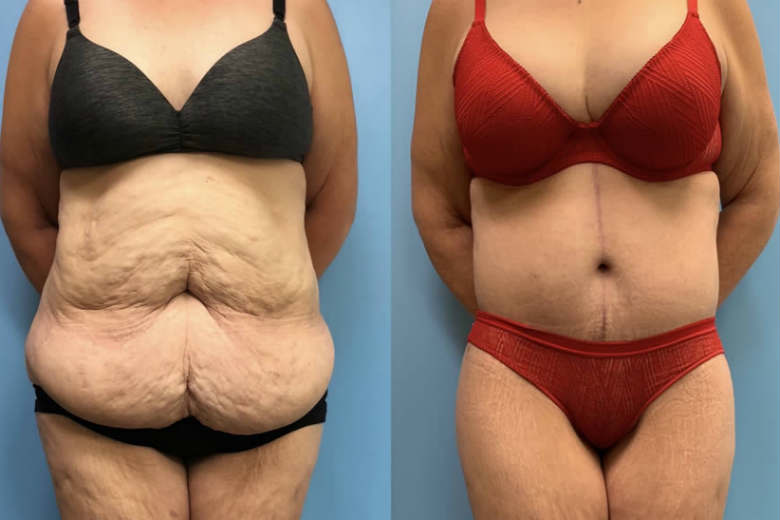 Body Lift Procedure Types Side Effects And Costs Body Lift Procedure Types Side Effects And Costs